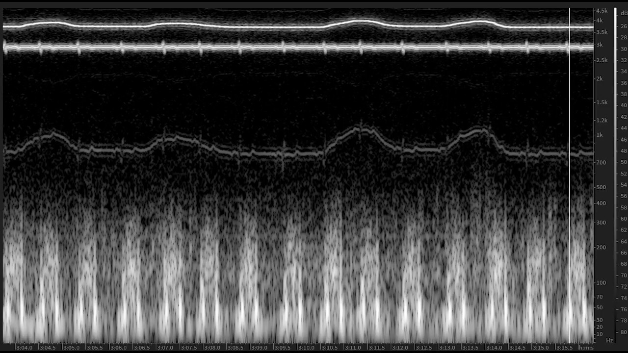 Heart Sound Lab 58-02 (1955). Pure pulmonary stenosis; diastolic "whisp ...