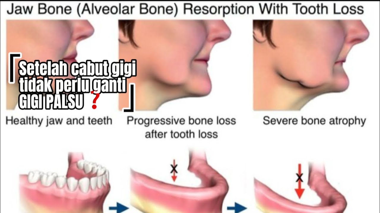 Habis cabut gigi perlu pakai GIGI PALSU INI AKIBATNYA KALAU TIDAK PAKAI GIGI PALSU!! - YouTube
