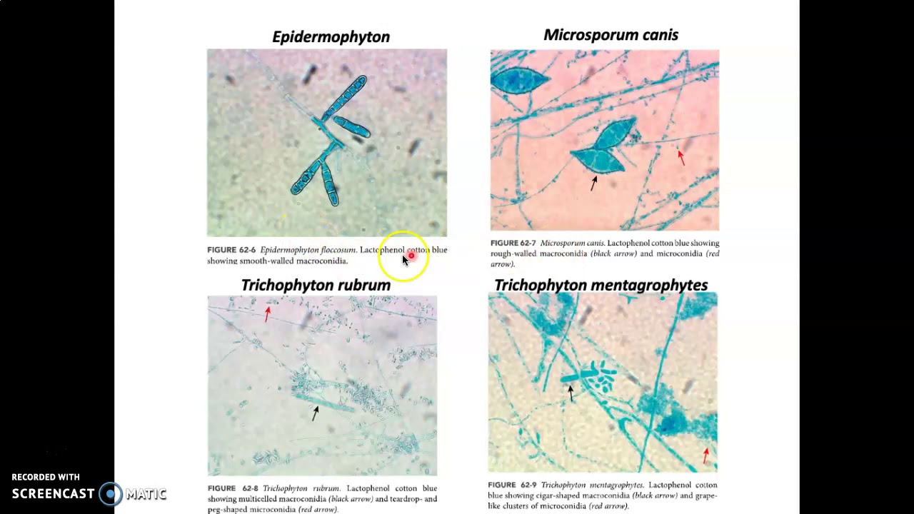 Dermatofitosis - YouTube