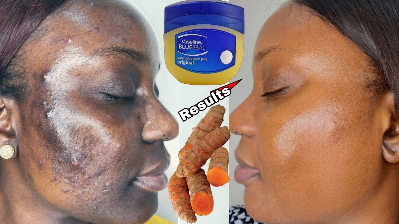 Apply vaseline & Turmeric on face to remove dark spots in 3 Day's-Best ...
