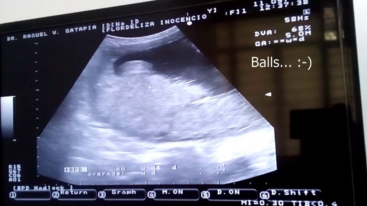 31 weeks - Baby ultrasound - YouTube