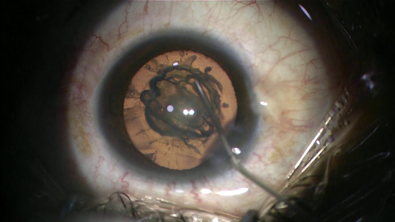 Facoemulsificación en Iridocyclitis Heterocromica de Fuchs - YouTube