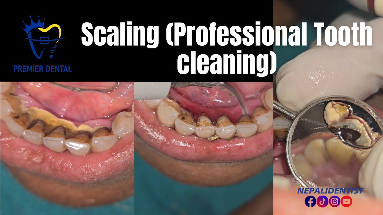 scaling / Professional tooth cleaning / calculus removal #scaling - YouTube