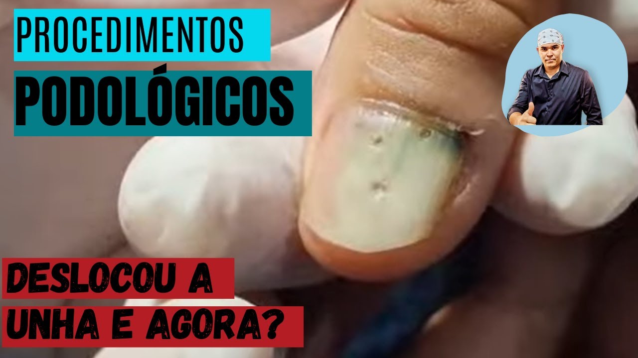 PROCEDIMENTOS PODOLOGICOS - unha deslocada - YouTube