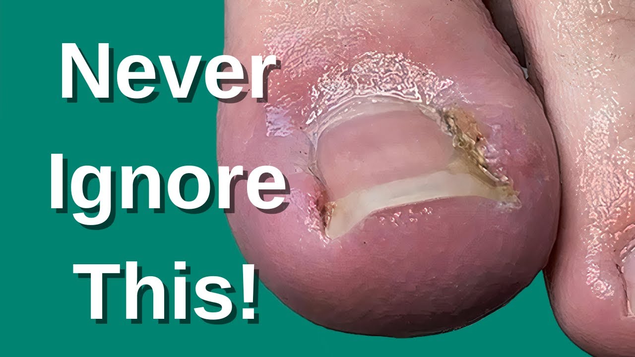What REALLY Happens When You Ignore Ingrown Toenail Pain? - YouTube