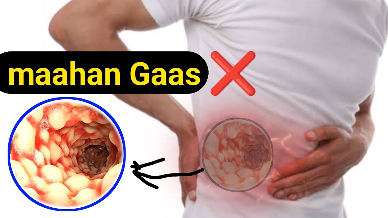 xanuunka crohn's disease ee lagu qaldo Gaaska iyo Tiifoowga - YouTube