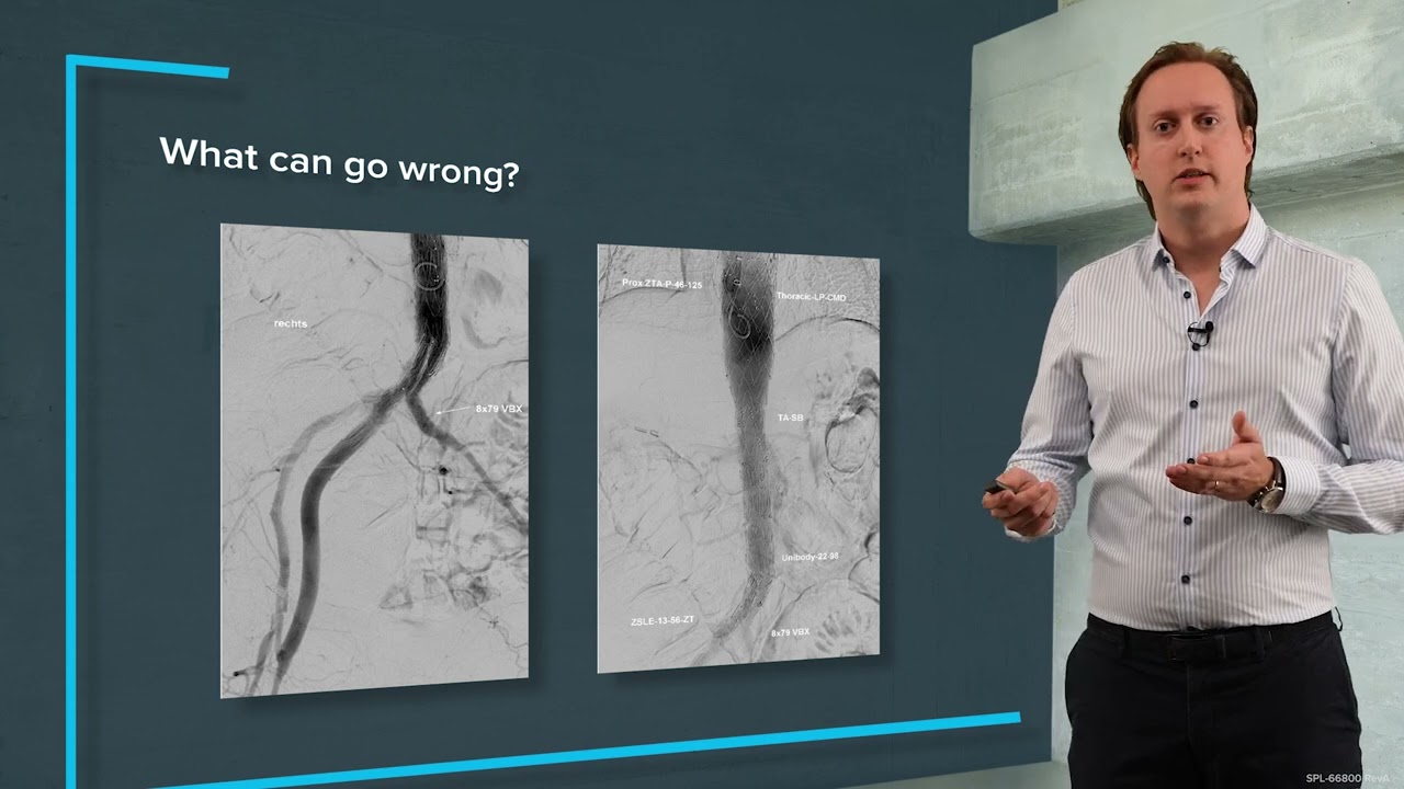IVL Pre-EVAR/TEVAR Tutorial, Chapter 1: Challenges of Hostile Calcified ...