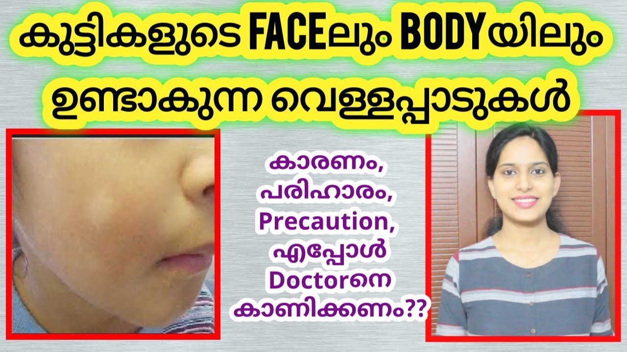White Patches On Baby s Face And Body White Spot Pregnancy Lactation white-patches-on-baby-s-face-and-body-white-spot-pregnancy-lactation