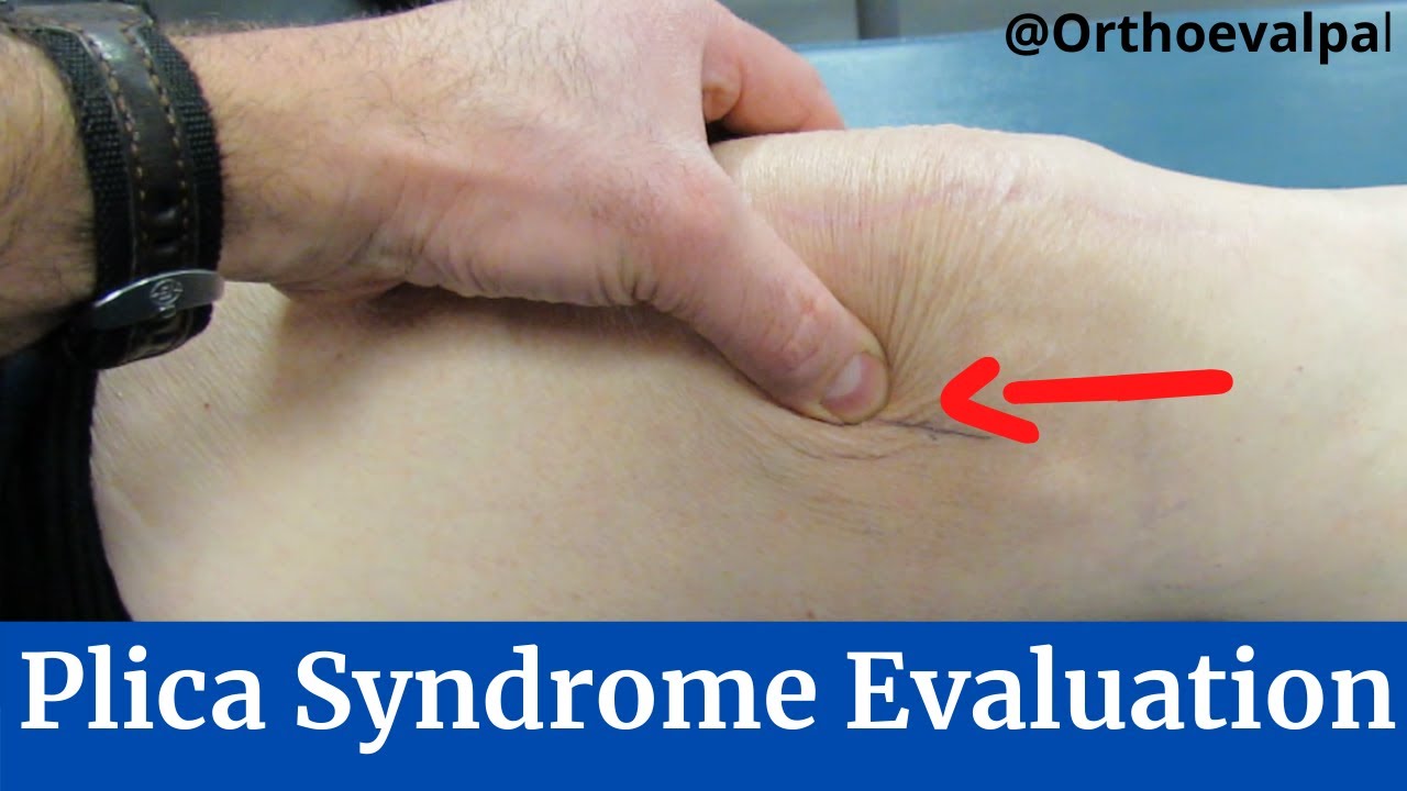 Plica Syndrome Evaluation of the Knee - YouTube