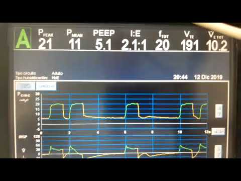 Asincronia paciente ventilador: Doble disparo - YouTube