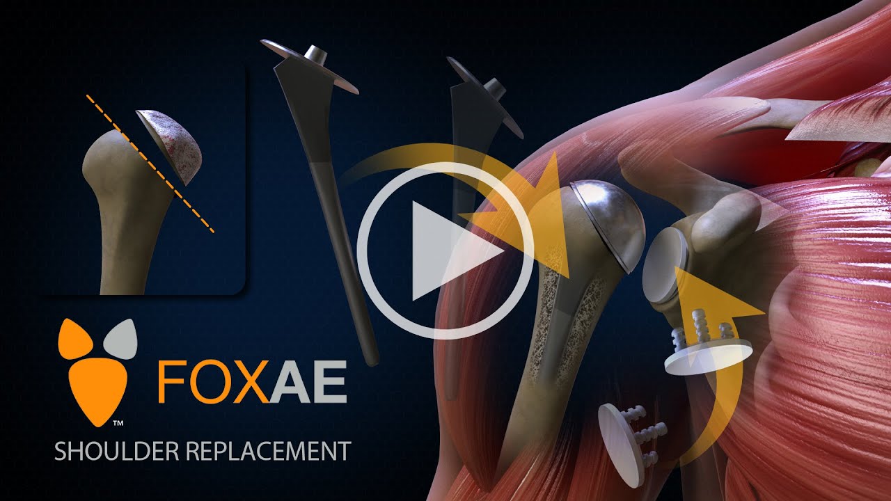 Shoulder Replacement Surgery | Legal Animation | Surgery Demonstration ...