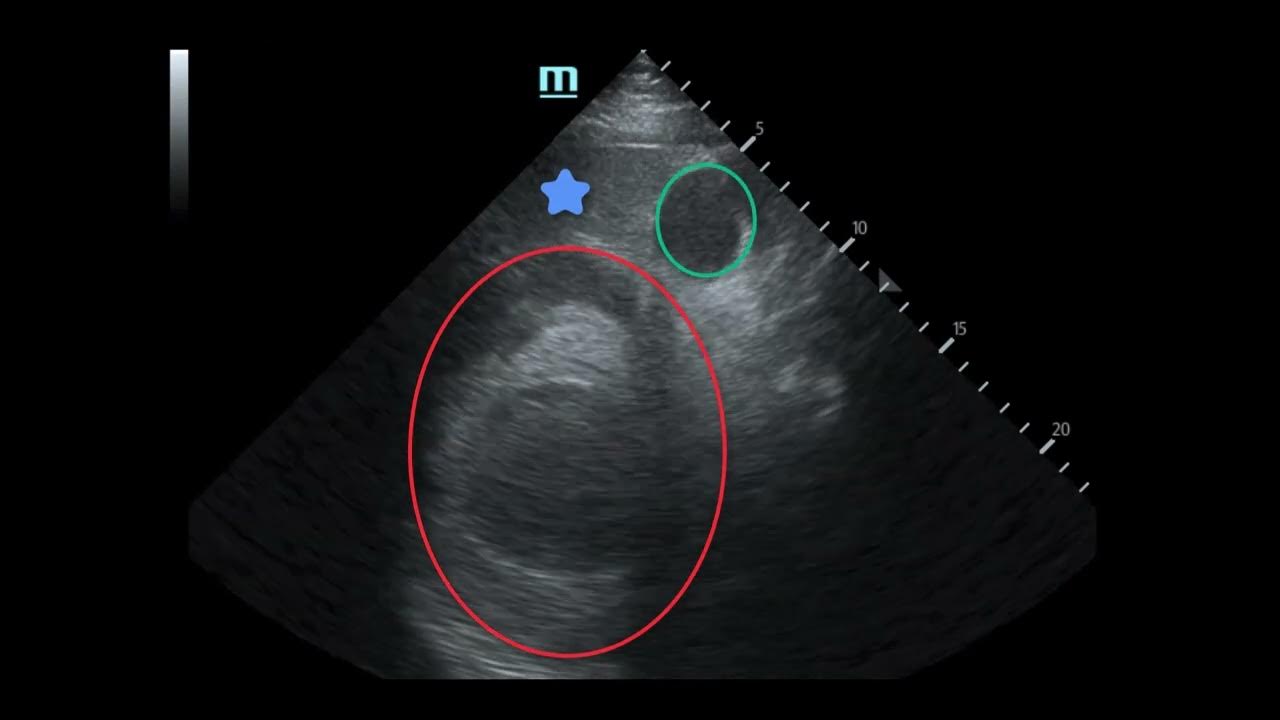 Massive Traumatic Retroperitoneal Hematoma, US 1, Annotated - YouTube