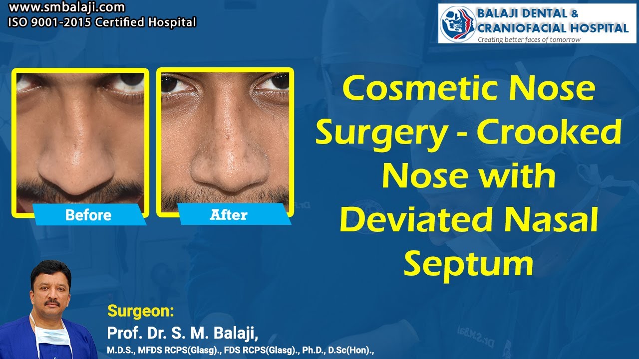 Cosmetic Nose Surgery - Crooked Nose with Deviated Nasal Septum - YouTube