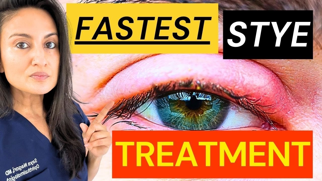 Eye Stye Treatment - Best Way To Get Rid Of A Stye Fast Without Eyelid ...