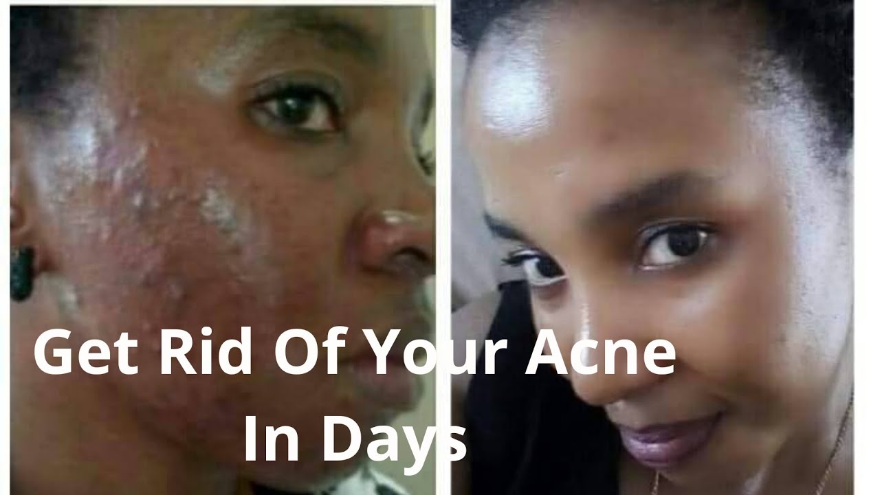 Best Acne Removing Face cream/ Best Way to Get rid of your acne and ...