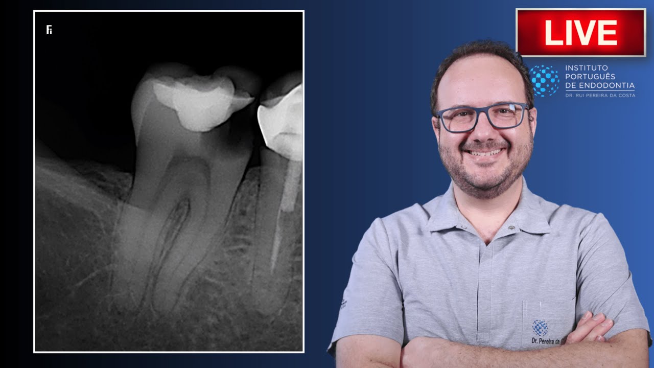 Endo Tx of 🦷47 with Irreversible Pulpitis - Pre-endo Restoration and ...