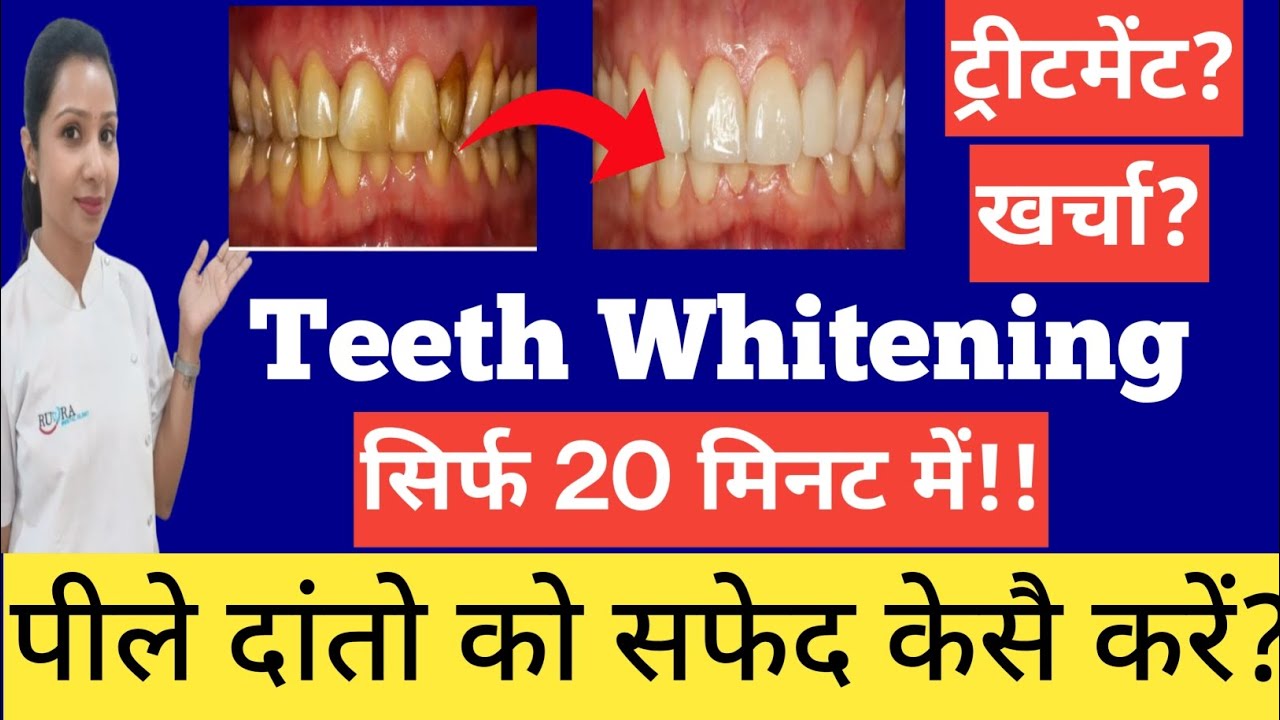 Dant Ko Safed Kaise Karen |Dant Ka Pilapan Kaise Hataye |Teeth ...