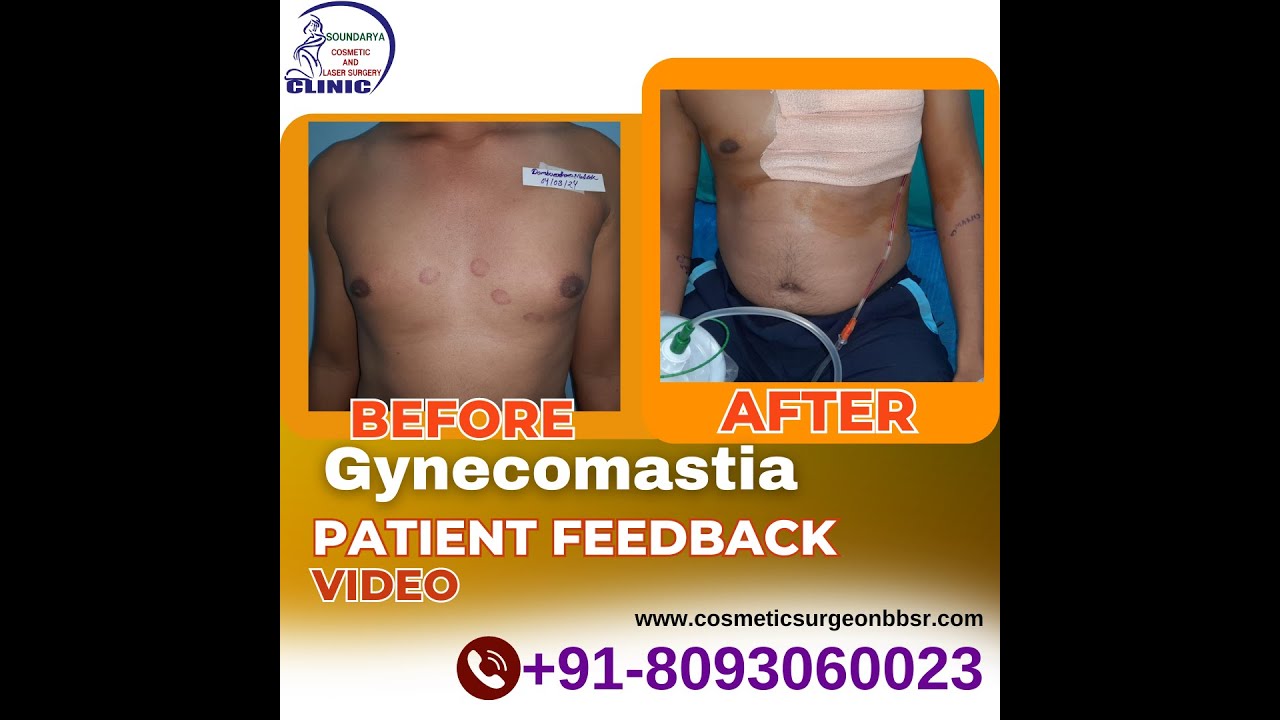 Gynecomastia patient feedback Video/Dr. Laxmikanta Mishra//Soundarya ...