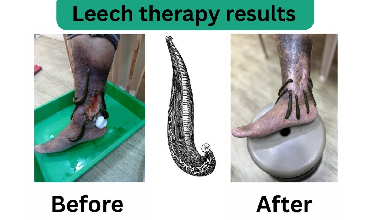 How do you treat a non-healing ulcer? ( LEECH THERAPY )#kzhijama # ...