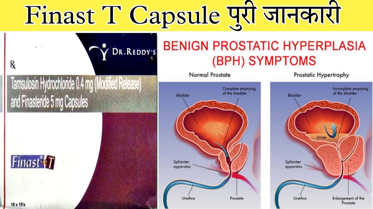 Finast T Capsule | Tamsulosin and Finasteride Capsule | Uses | Dose ...