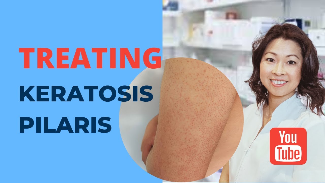 Treating keratosis pilaris (KP) AKA Chicken skin, goose-bump skin ...