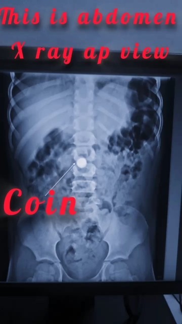 x ray of abdomen ap view #xray showing coin metallic artifact #inshort ...