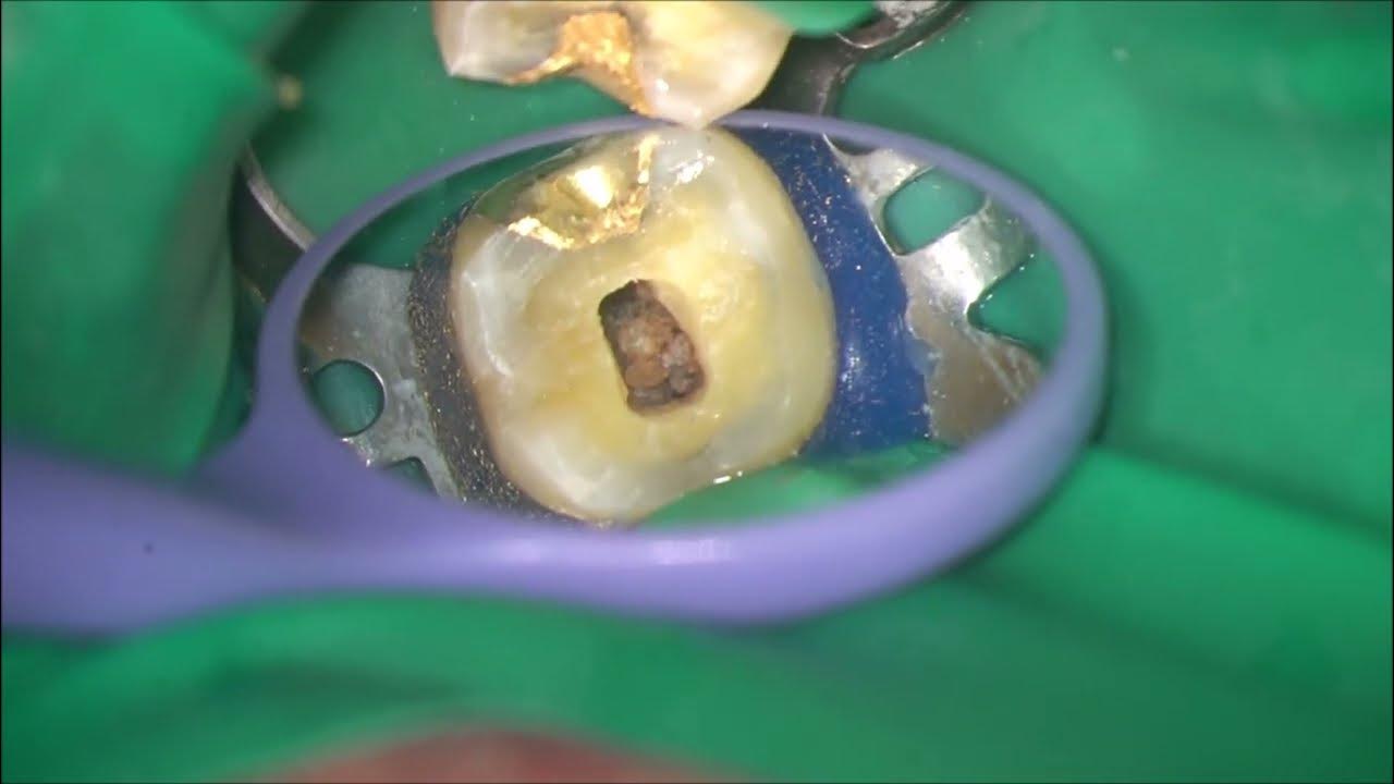 The removal of adherent pulp stones using ultrasonic device - YouTube