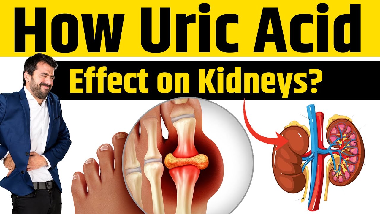 How Uric Acid Effect on Kidneys? | Uric Acid Badhane Ka Karan | Kidney ...