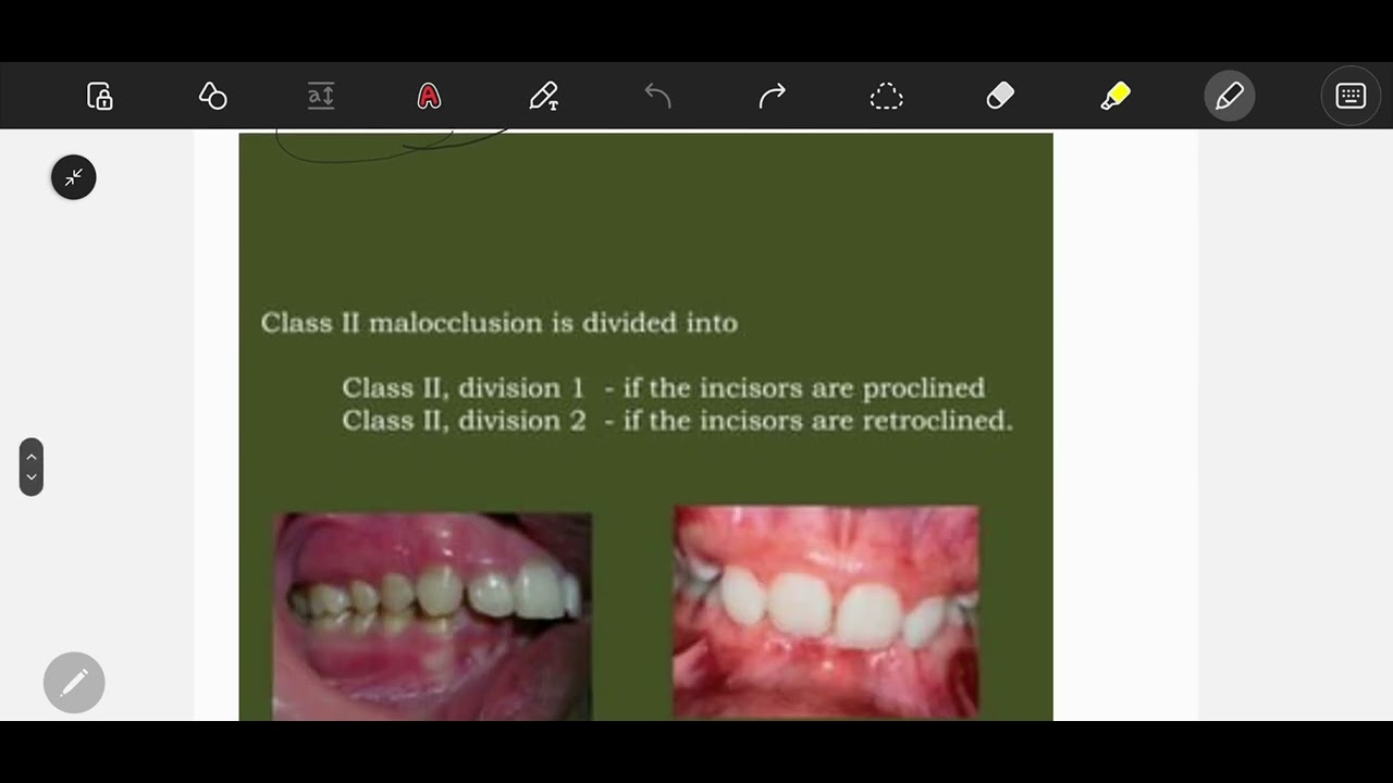 ortho classification and Cephalometric point - YouTube