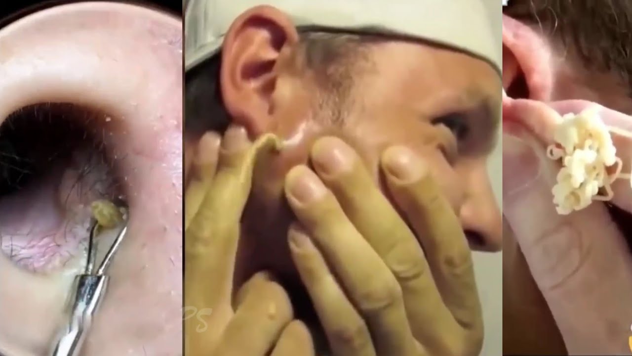 Tik Tok Pimple Popping