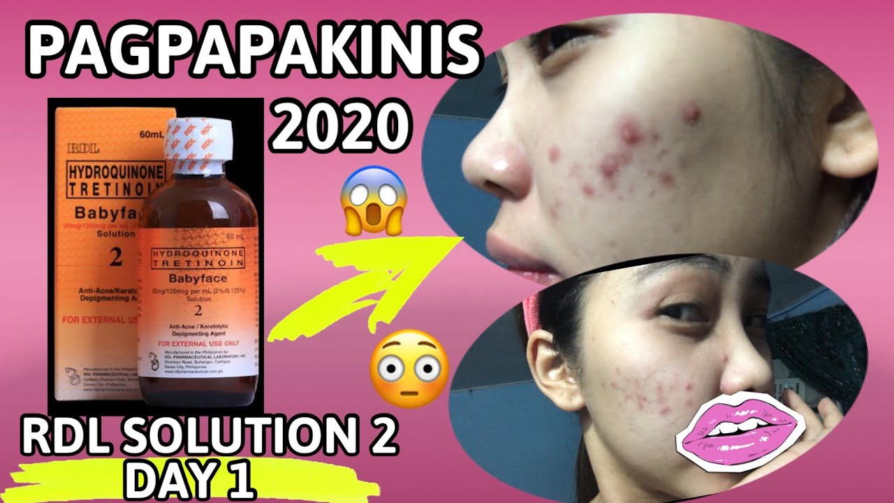 DAY 1: RDL BABY FACE SOLUTION #2 (JOURNEY TO PAGPAPAKINIS 2020) | Xhiia ...