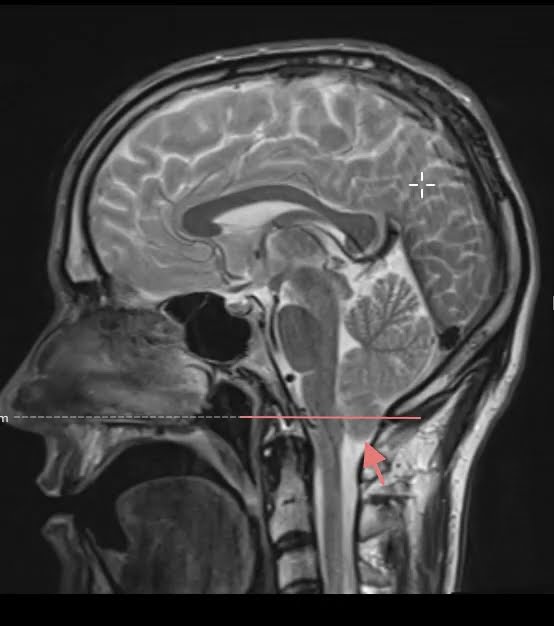 MRI brain for headaches, visual changes, and tinnitus - YouTube