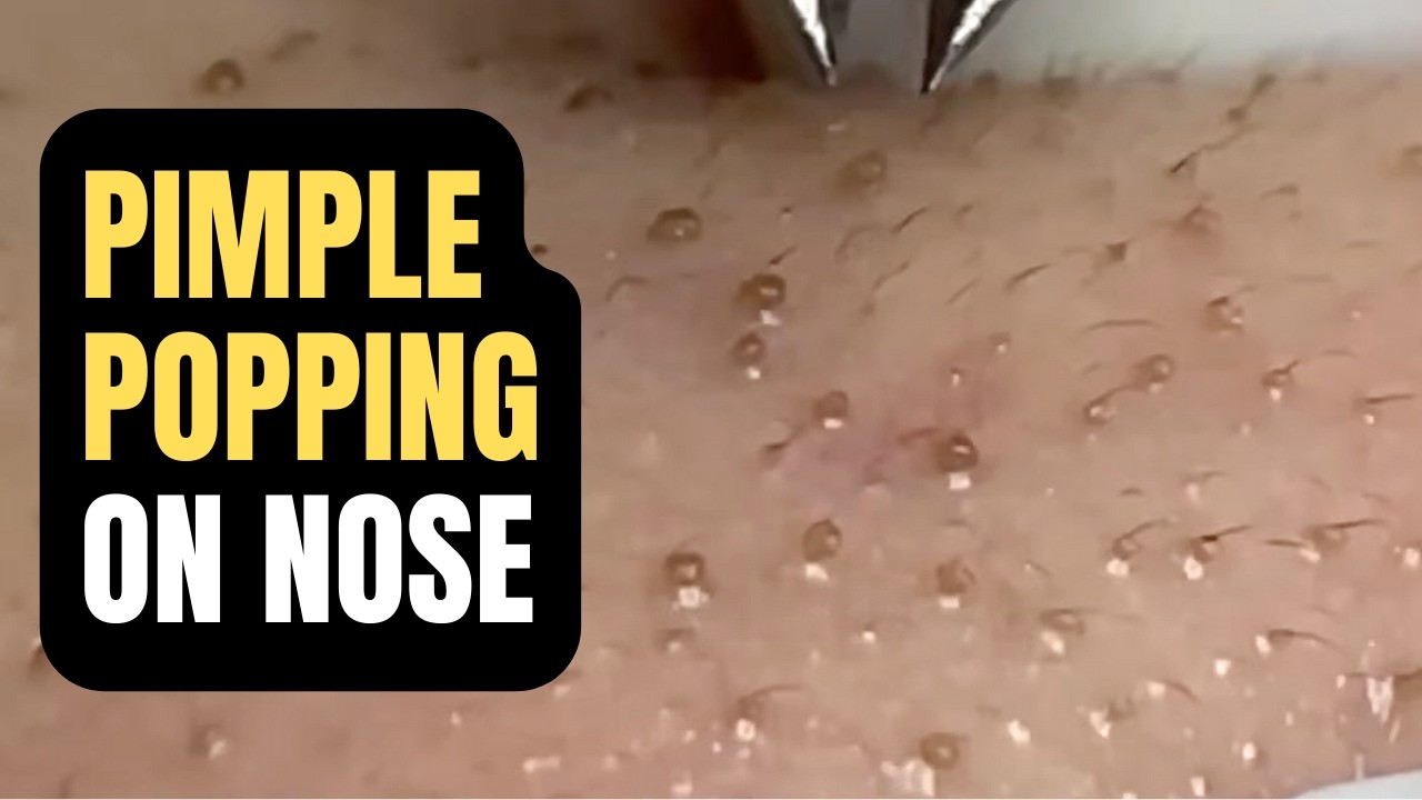 PIMPLE POPPING - BLACKHEAD REMOVAL TWEEZERS - YouTube Music