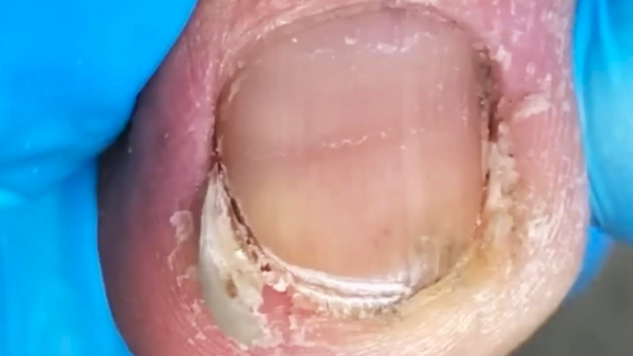 Very Short Toenails Long Ingrown Toenails - YouTube