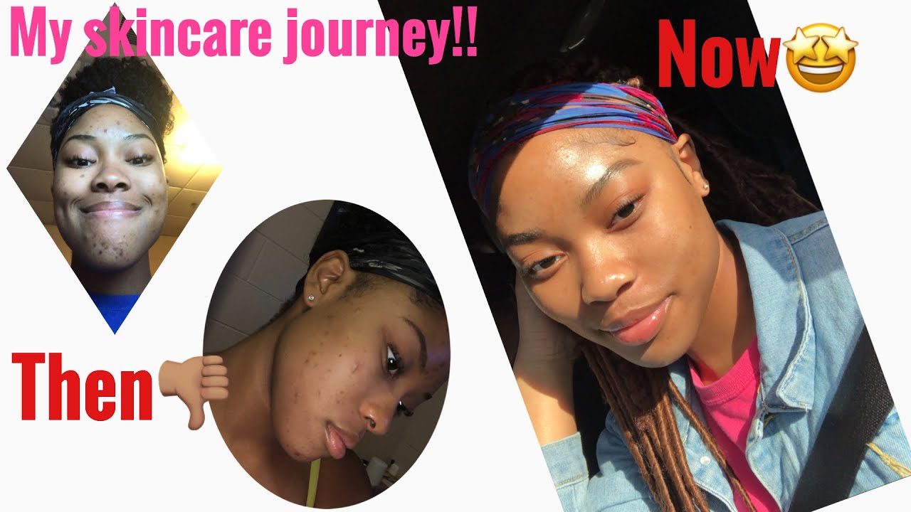 My SkinCare Journey (Part 1 of 2 skincare series) *HIGHLY REQUESTED ...