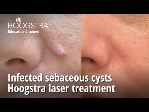 Infected sebaceous cysts - Hoogstra laser treatment - 22283 - YouTube