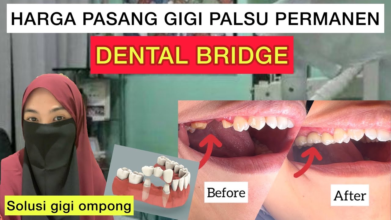 PENGALAMAN PASANG GIGI PALSU PERMANEN DENTAL BRIDGE, LENGKAP DENGAN ...