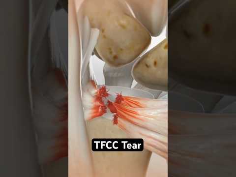 Wrist pain could be a tear (3D Animation)