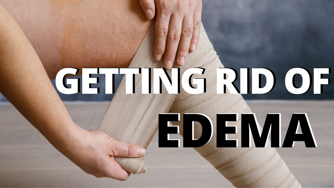 EDEMA - Causes and Natural Treatments - YouTube