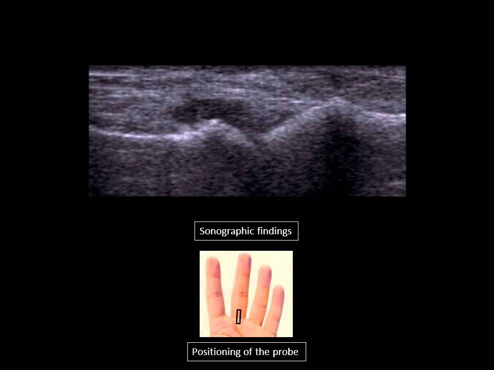 Metacarpophalangeal joint effusion at US - YouTube