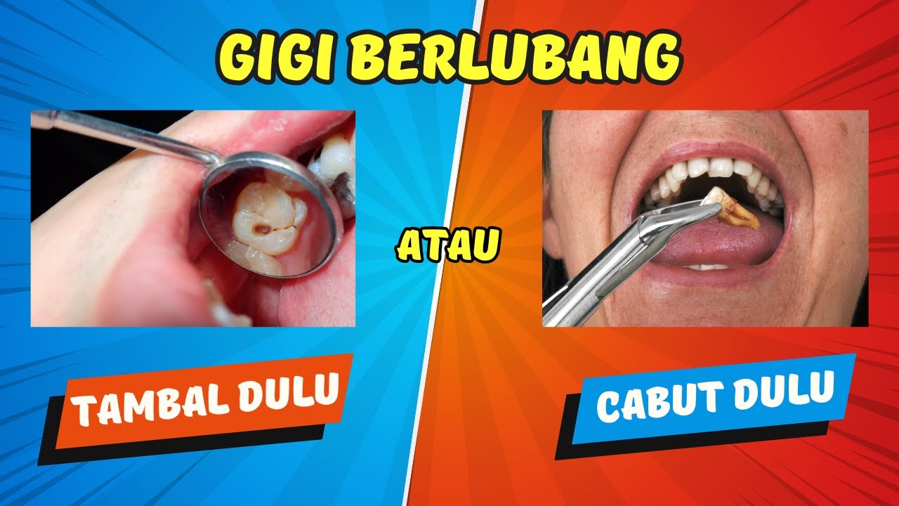 Gigi Berlubang Sebaiknya Dicabut atau Ditambal ? | Sakit Gigi ...