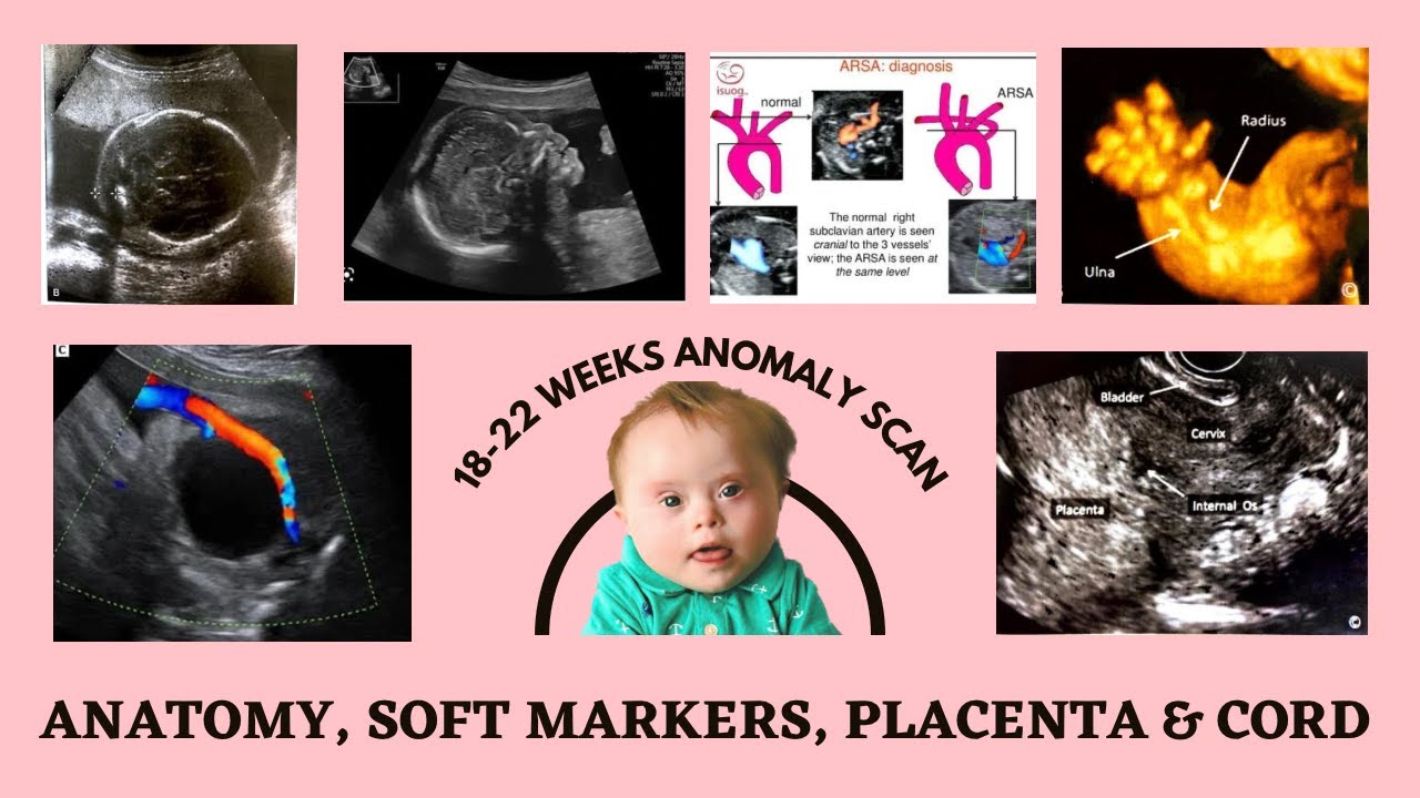 Anatomy, Soft Markers, Placenta & Cord | DrOzaConnects | Dr Nisheeth ...