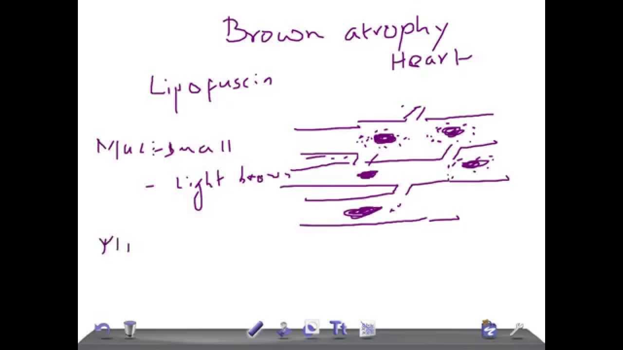 QUICK PATHOLOGY: Brown atrophy of Heart - YouTube