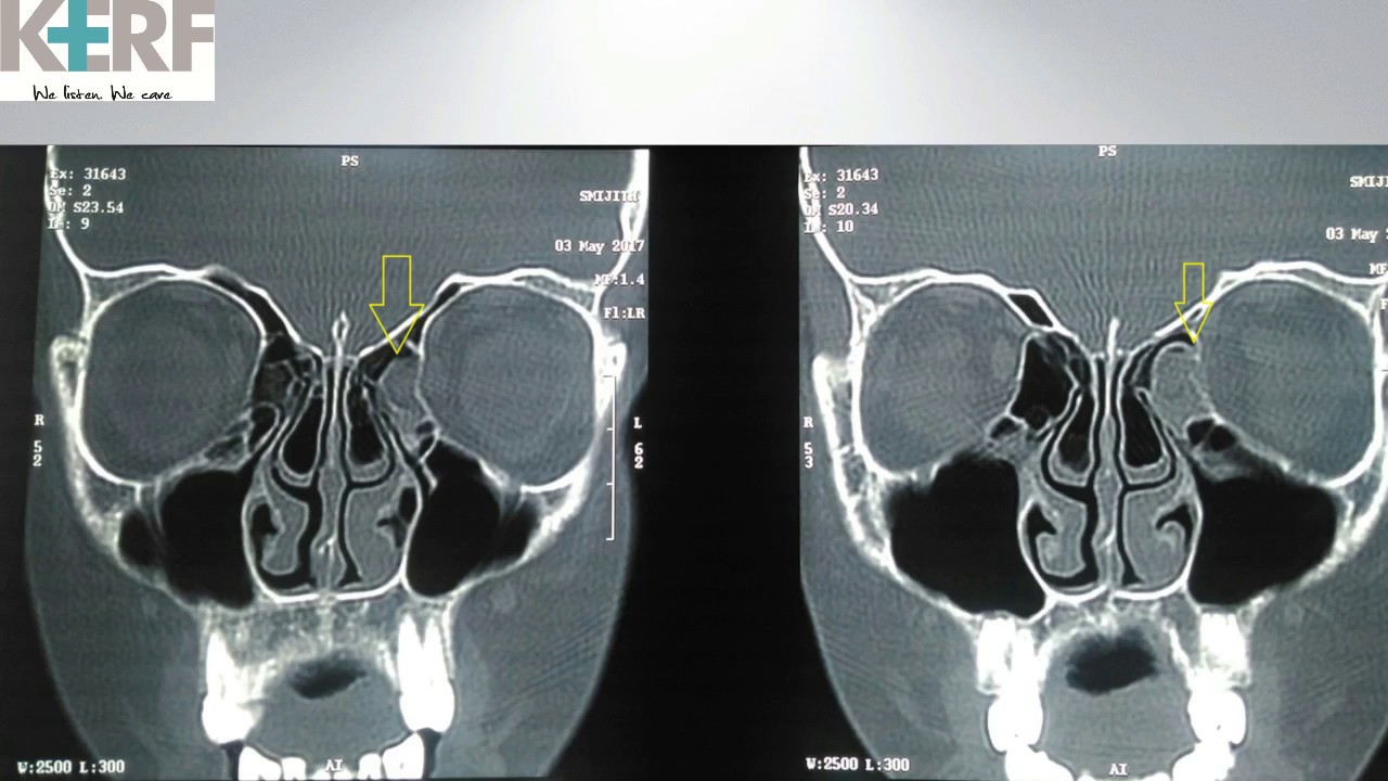 Medial Rectus Entrapment - Endoscopic Release - YouTube