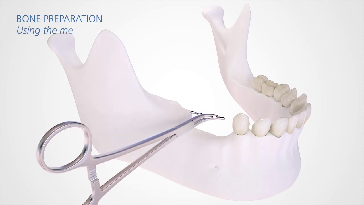 PRF Fast System ™ PRF Process - YouTube