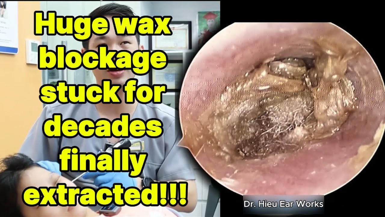 Huge wax blockage stuck for decades finally extrac | ear cleaning ...