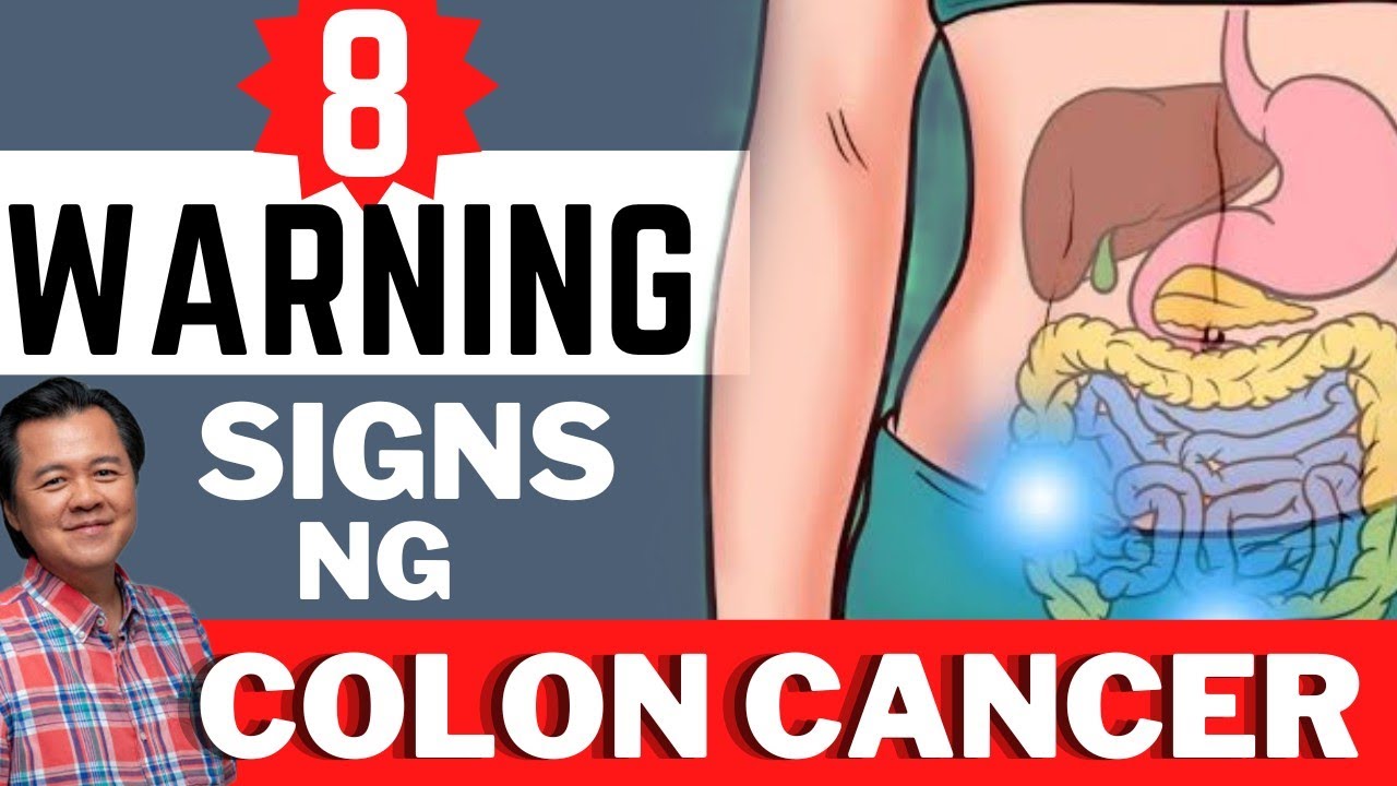 8 Warning Signs ng Colon Cancer - Payo ni Doc Willie Ong - YouTube