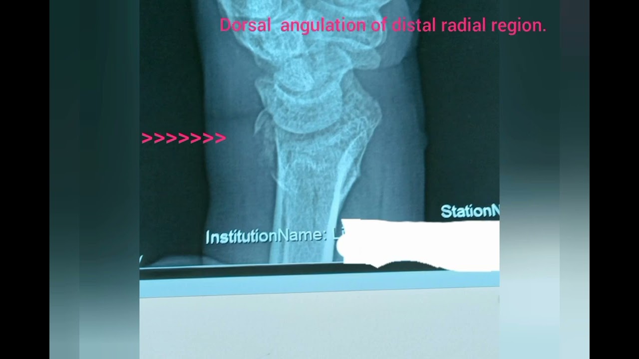colles fracture/xray findings/Radiology/short case - YouTube