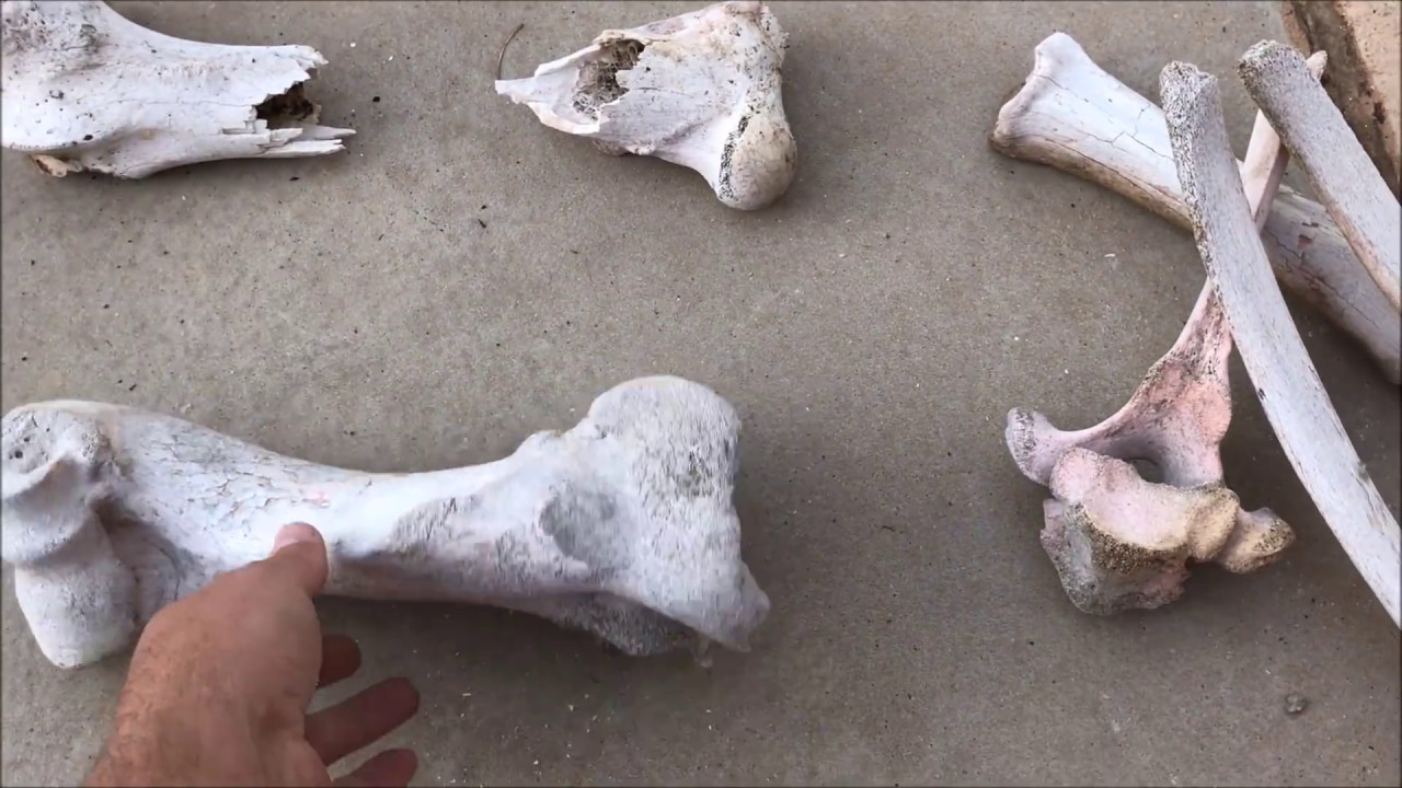 Broken femur bone snapped - YouTube