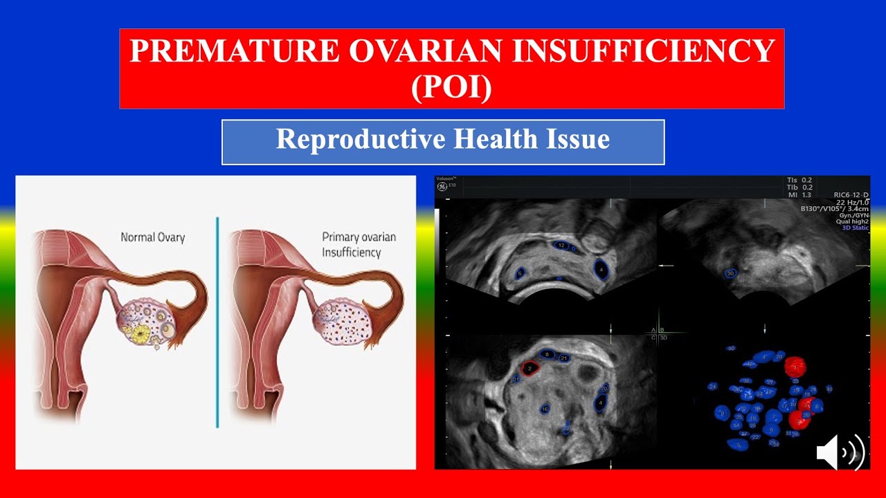 PREMATURE OVARIAN INSUFFICIENCY (POI) - Definition, types, causes ...